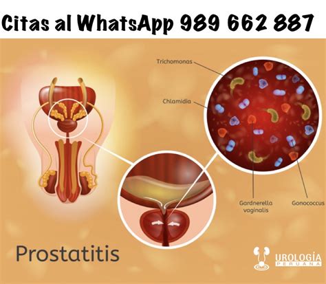 Tipos De Prostatitis Urología Peruana Dr Susaníbar