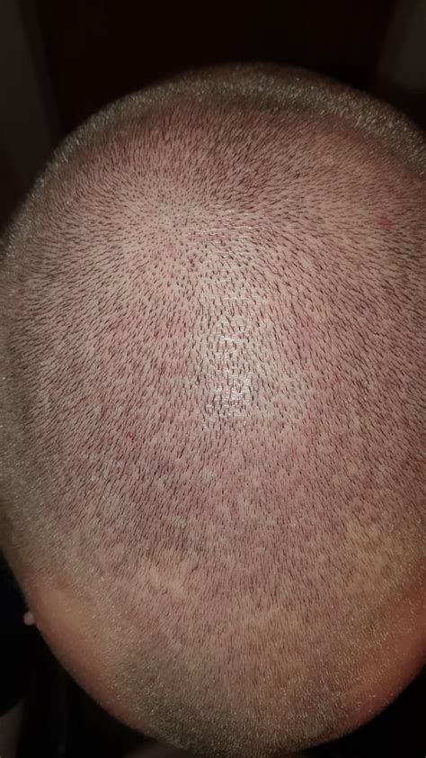 Is This Folliculitis Or Dry Scalp Or Something Else R Folliculitis