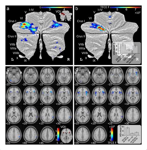 Conjunction Analyses Conjunction Analyses Testing Global Null Download Scientific Diagram