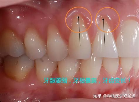 不想牙龈萎缩，请把精力花在这！ 知乎
