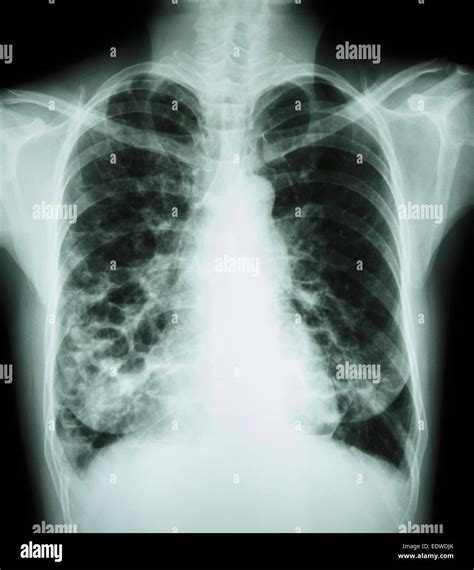 Bronchiectasis