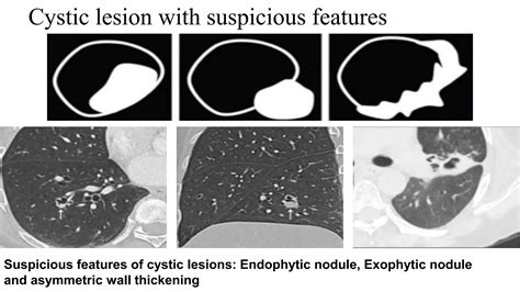 Approach To Imaging Of Solitary Pulmonary Nodule Pptx