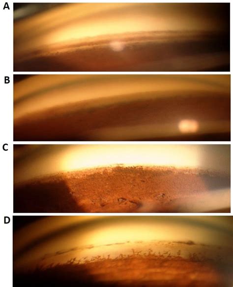 Iris Processes Gonioscopy Angle