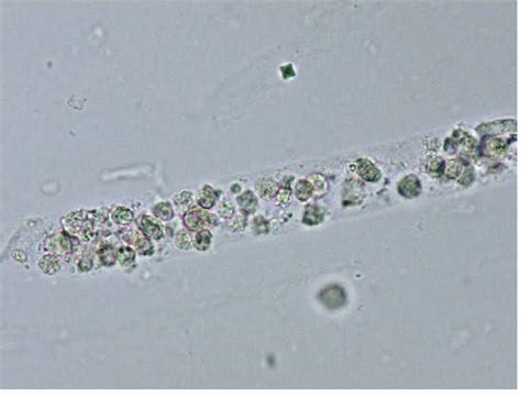 Wbc Cast In Urine