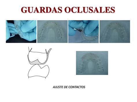 Ppt Guardas Oclusales Powerpoint Presentation Free Download Id2177752