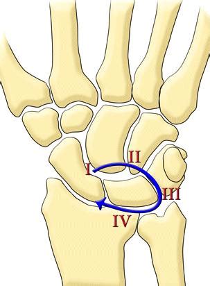 Perilunate Vs Lunate Dislocation
