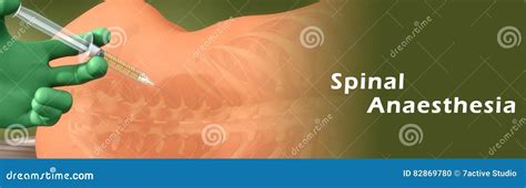 Spinal Anaesthesia Stock Illustration Illustration Of Anesthesia 82869780