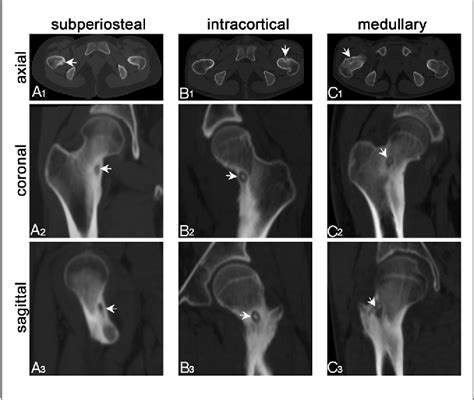 Figure 1 From Osteoid Osteoma Of The Proximal Femur Pitfalls In