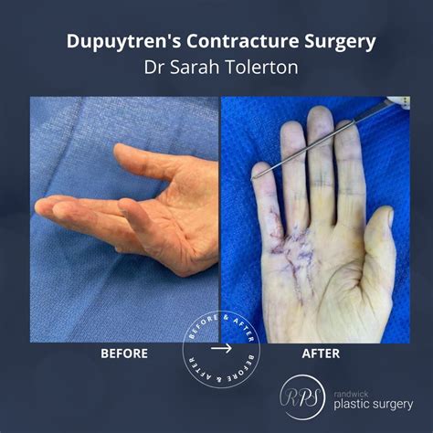 Hand Surgery Gallery Randwick Plastic Surgery