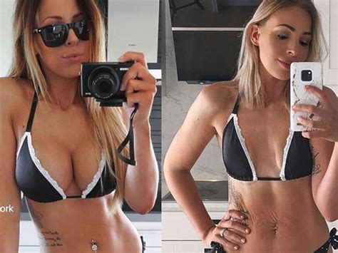 How Many Years Will My Breast Implants Last A Comprehensive Guide