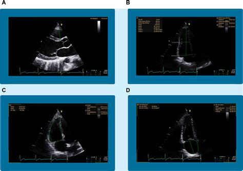 Frontiers Sex Differences In The Associations Between Right Heart Structure And Peak Exercise