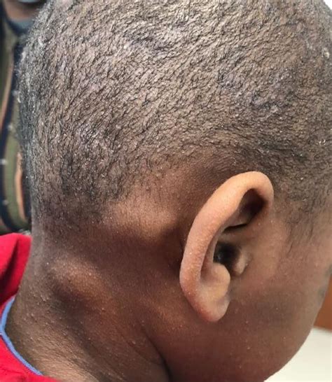 Dermdx Scalp Lesions With Drainage And Lymphadenopathy Clinical Advisor