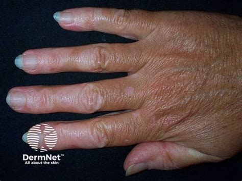 Vitiligo Images — Dermnet
