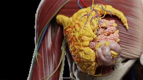 3d Model Of Benign Phyllodes Tumor Voka