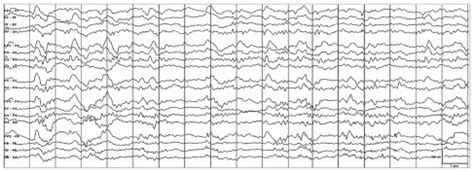 Scalp Electroencephalogram EEG Showing Continuous Generalized Slowing Download Scientific