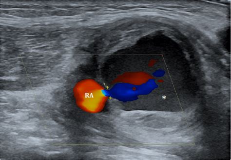 Duplex Ultrasound Image Of The Pseudoaneurysm Arising From The Download Scientific Diagram