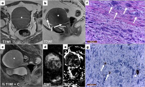 Axial T1wi A Sagittal T2wi B Sagittal Fatsaturated Post Contrast