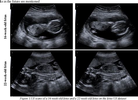 Figure 1 From Fetal Movement Detection And Anatomical Plane Recognition Using Yolov5 Network In