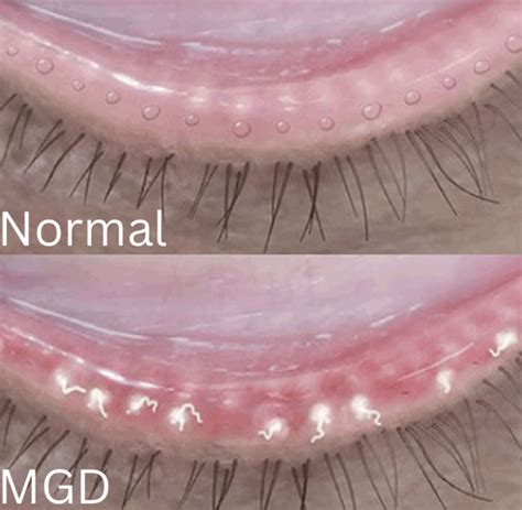 Blepharitis Peckham Eye Clinic