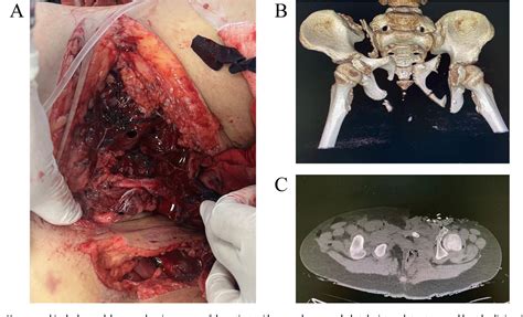 Figure 1 From A Case Report Of Severe Unstable Pelvic Fracture With