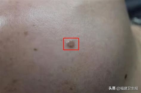萬萬沒想到！福安女教師臉上有「痣」5年，竟然是皮膚癌 每日頭條