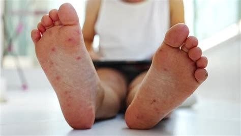 Maculopapular Bilder Durchsuchen 70 Archivfotos Vektorgrafiken Und Videos Adobe Stock