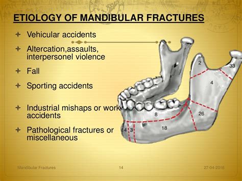 Mandibular Fractures