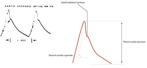 Interpretation Of Abnormal Arterial Line Waveforms Deranged Physiology