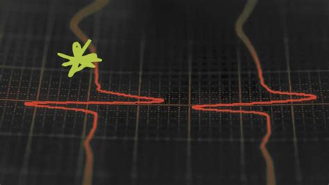 Afib Targeting Macrophages May Help Treat And Prevent Condition