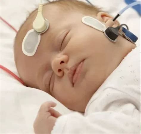 Auditory Brainstem Response Or Brainstem Evoked Response Audiometry Abr Or Bera Services At