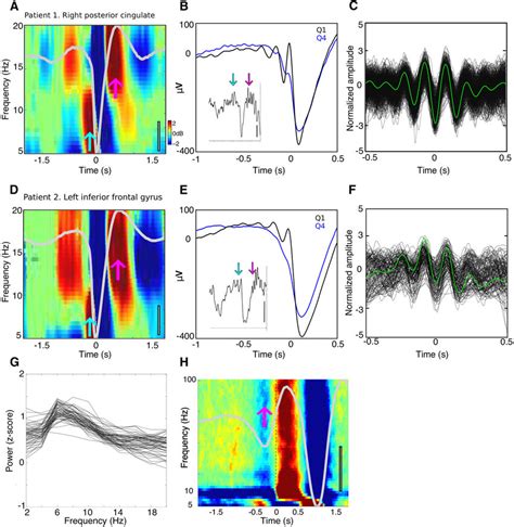 Cortical Theta During Nrem Sleep A C Patient 1 Right Posterior Download Scientific Diagram