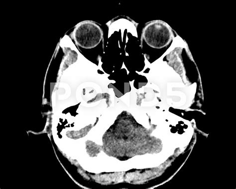 Cat Scan Brain Tumor