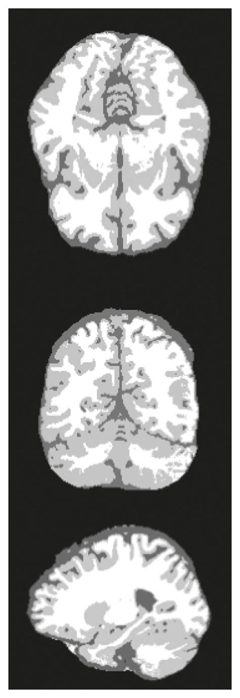Intensity Inhomogeneity Correction Of Brain Mr Images A Original Mr