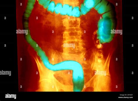 Hummus Ulcerative Colitis At Melinda Morris Blog