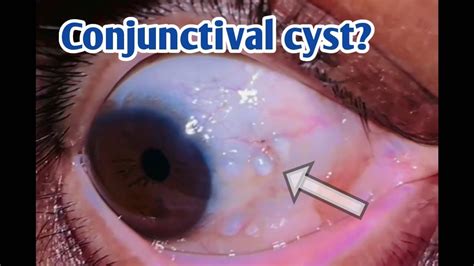 Conjunctival Cyst Condition Explained Indetail Eyecareoptom5506