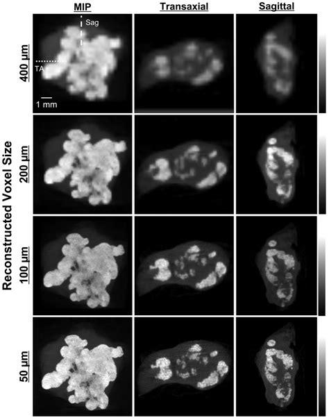 Ex Vivo Imaging Of Breast Cancer Microcalcifications High Resolution Download Scientific