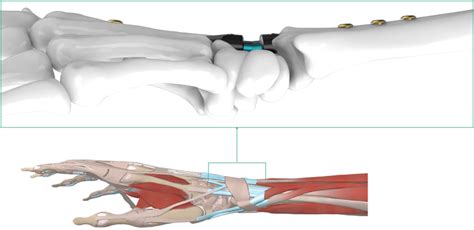 Implate® Wrist Arthrodesis Nail Skeletal Dynamics