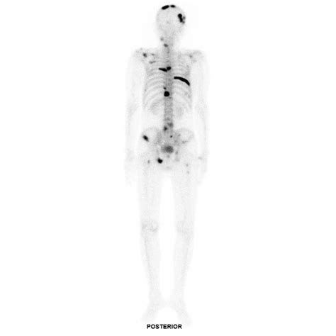 auttawit bone scan classification with model mobilenet at main