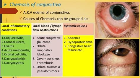 New Real Conjunctiva Episclera Sclera