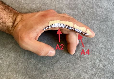 Lésion De Poulies Et Rééducation Lésion De Poulies Et Rééducation