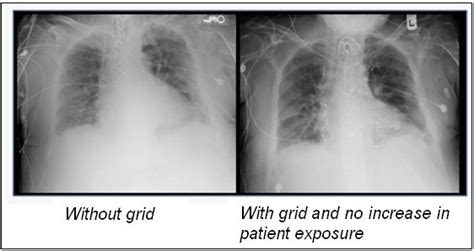 Radiography Grid Types Appspolf