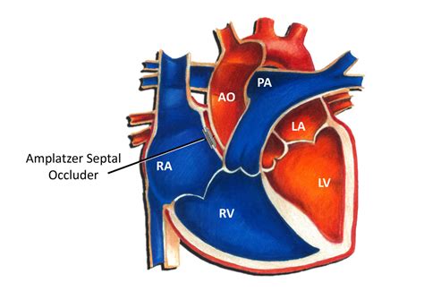 Atrial Septal Defect Device Closure Pediatric Heart Specialists