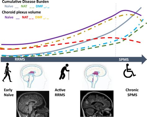 Choroid Plexus Volumetrics And Brain Inflammation In Multiple Sclerosis Pmc