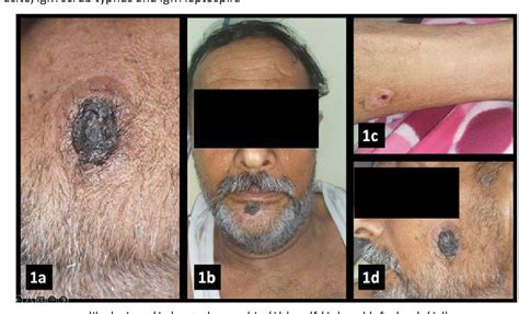 Figure 1 From A Rare Presentation Of Ecthyma Gangrenosum Like Lesions