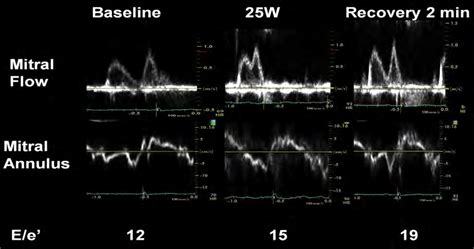 Mitral Flow And Annular Velocity At Rest During Supine Bicycle