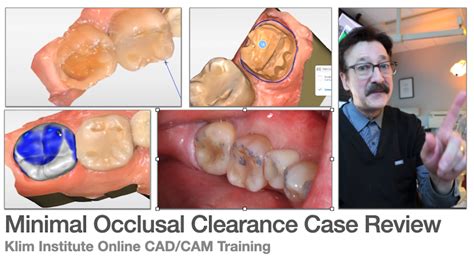 Minimal Occlusal Clearance Case Review Cadstar