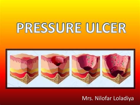 Pressure Ulcerpptx