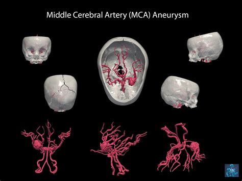 3d Model Of Middle Cerebral Artery Aneurysm 3d Model 3d Printable Cgtrader