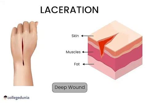 Laceration In 2025 Wounds Sfx Makeup Wind