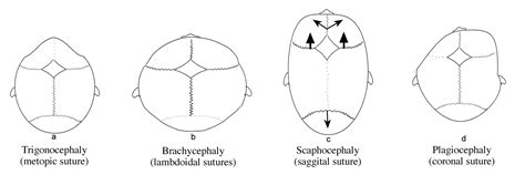 Craniosynostosis Cranial Therapy Centers